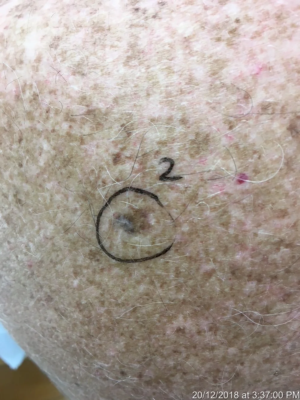 Suspicious Skin Lesions | Skin Concerns and Treatments — Aesthetica ...