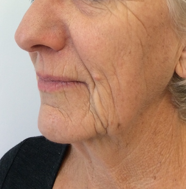 Loss of Skin Firmness in the Face and Neck | Appearance Concerns and ...