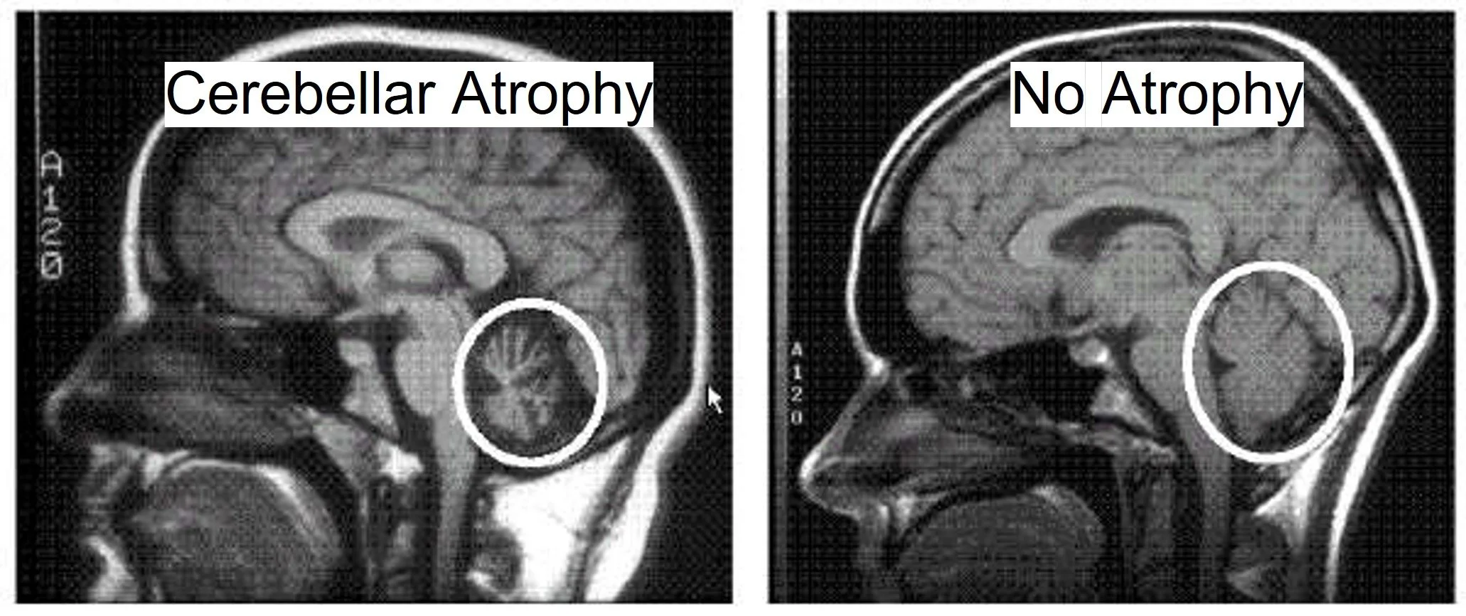 SCA27b Ataxia Foundation