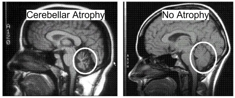 SCA27b Ataxia Foundation
