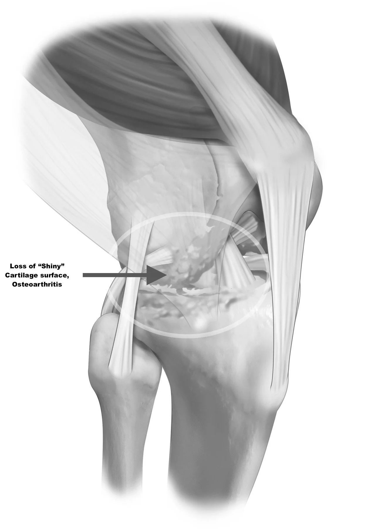 Knee Injuries: Knee Osteoarthritis — Nick The Knee MD