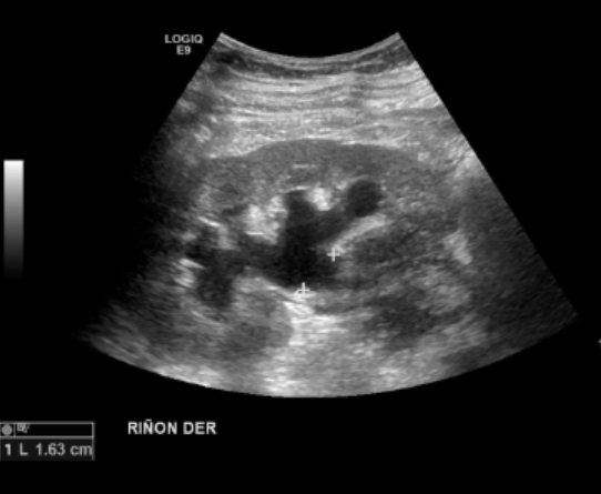 Caso clínico carcinoma de células transicionales / masa renal ...