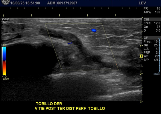 Trombosis venosa profunda y tromboflebitis — Asesoría y Gestion Radiológica
