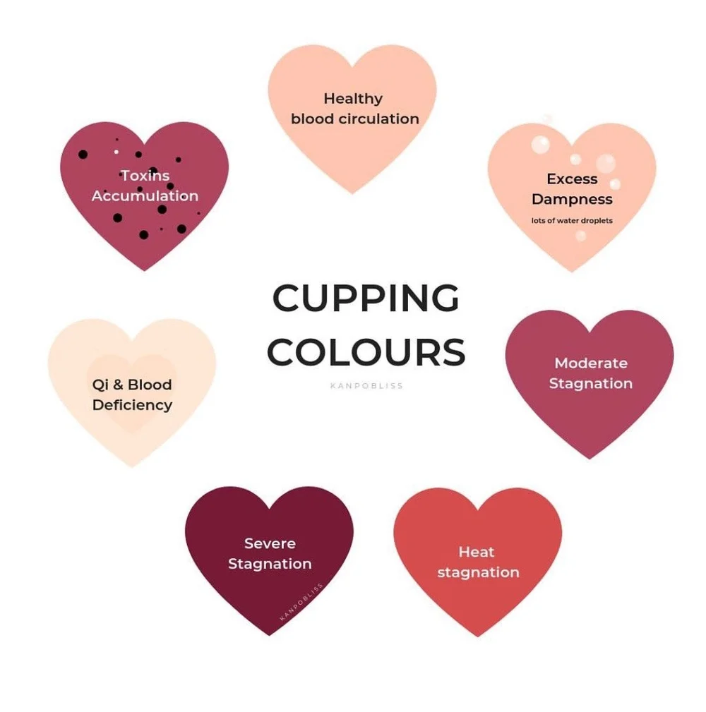 Your Guide to FIRE CUPPING — Well Forest Acupuncture