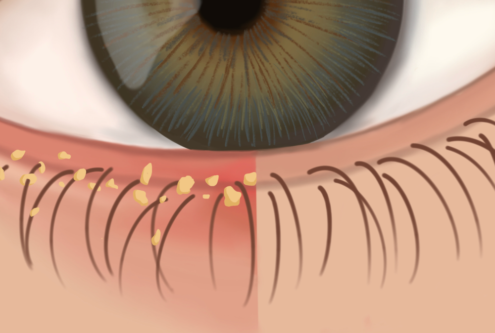 Blepharitis / Demodex | Learn More Today — Sunshine Optometry