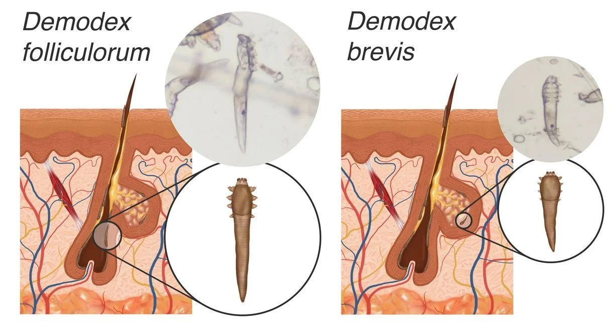 Blepharitis Demodex Learn More Today — Sunshine Optometry