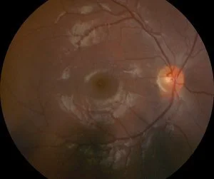 A Retinal Photo is Worth a Thousand Words — Sunshine Optometry