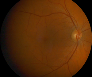A Retinal Photo is Worth a Thousand Words — Sunshine Optometry