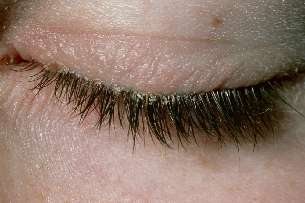 Blepharitis / Demodex | Learn More Today — Sunshine Optometry