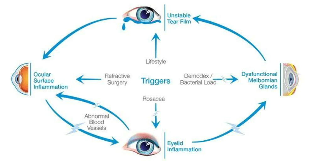 Dry Eye Center | Relieve Dry Eye Today — Sunshine Optometry