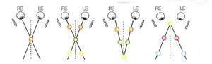 How to Use a Brock String for Convergence Insufficiency Eye Exercises ...