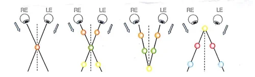 How to Use a Brock String for Convergence Insufficiency Eye Exercises ...
