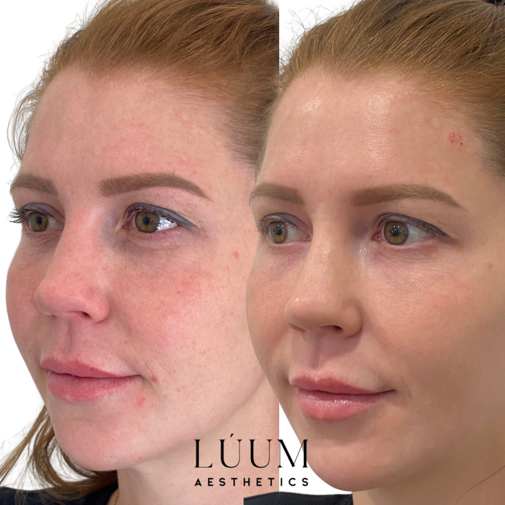 Laser Therapy & Treatment For Pigmentation | Hollywood Spectra