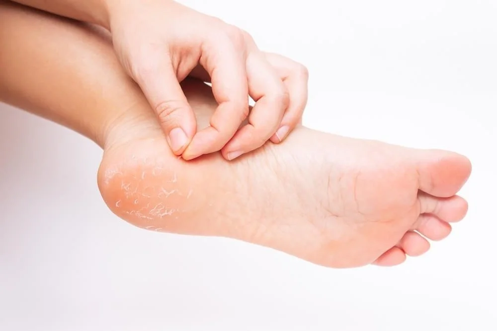Foot Psoriasis Treatment — New York Foot Health | NYSPMA | New York ...