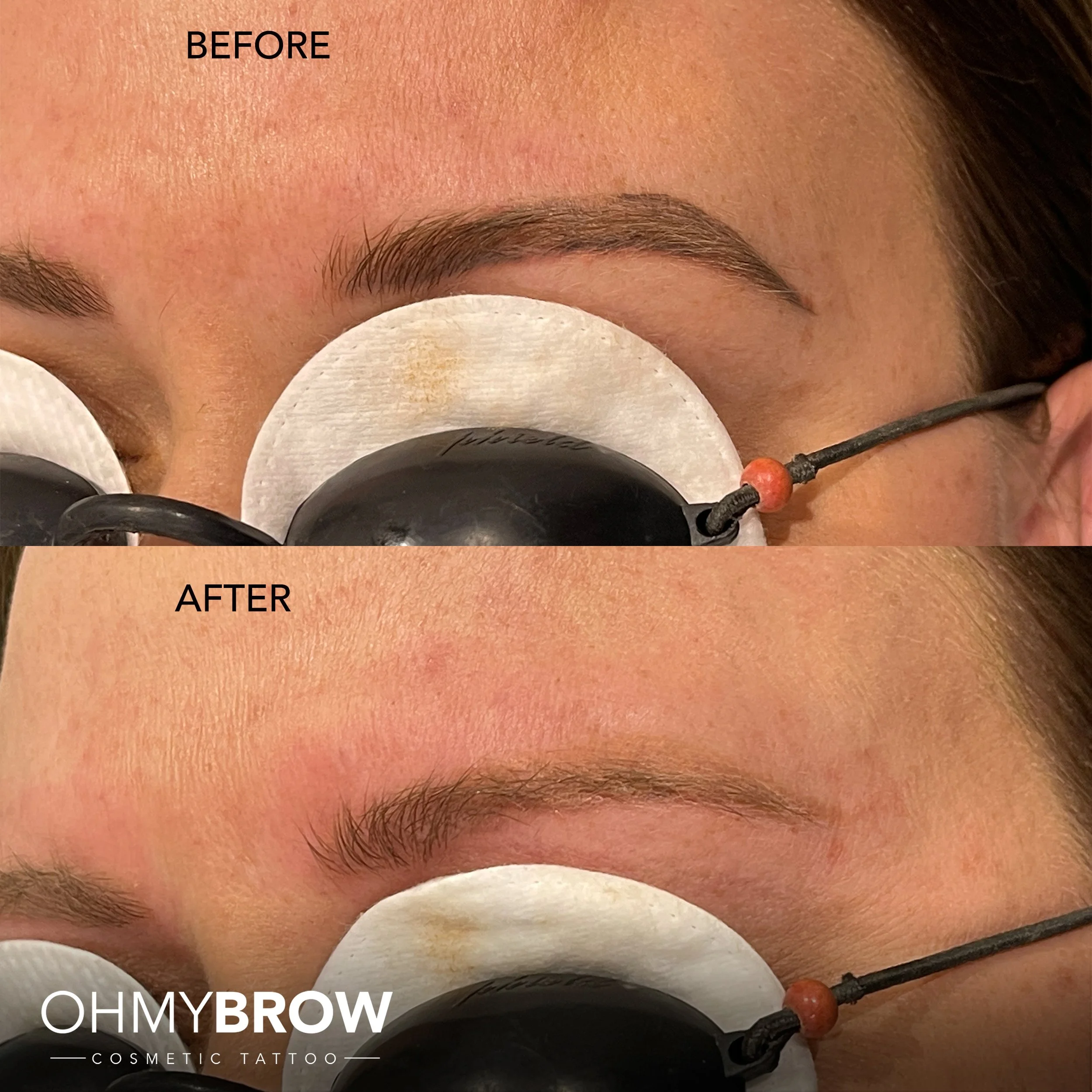 Cosmetic Tattoo Removal Adelaide Australia — OHMYBROW