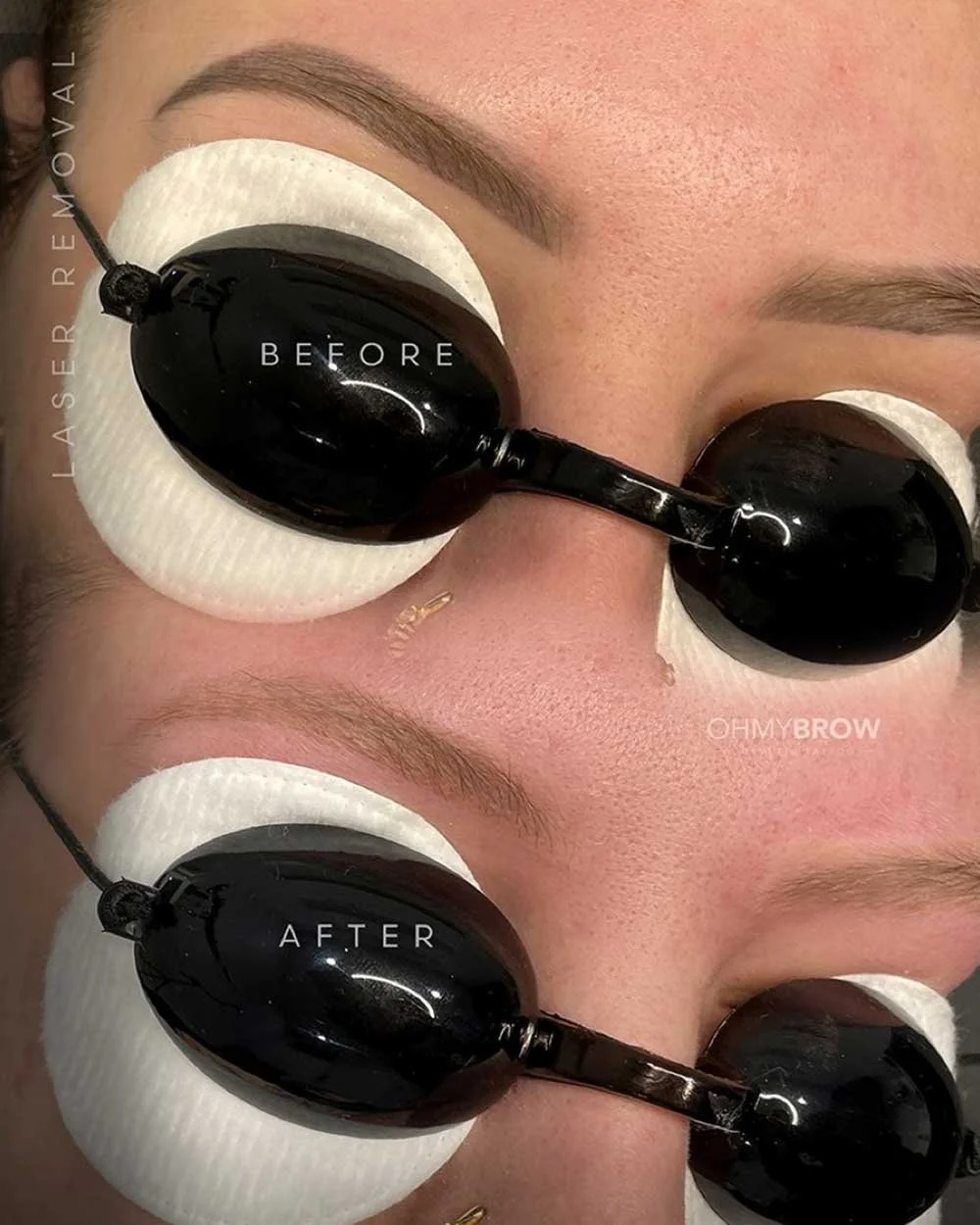 10 Laser Eyebrow Tattoo Removal Before and After Cases & What They Had ...
