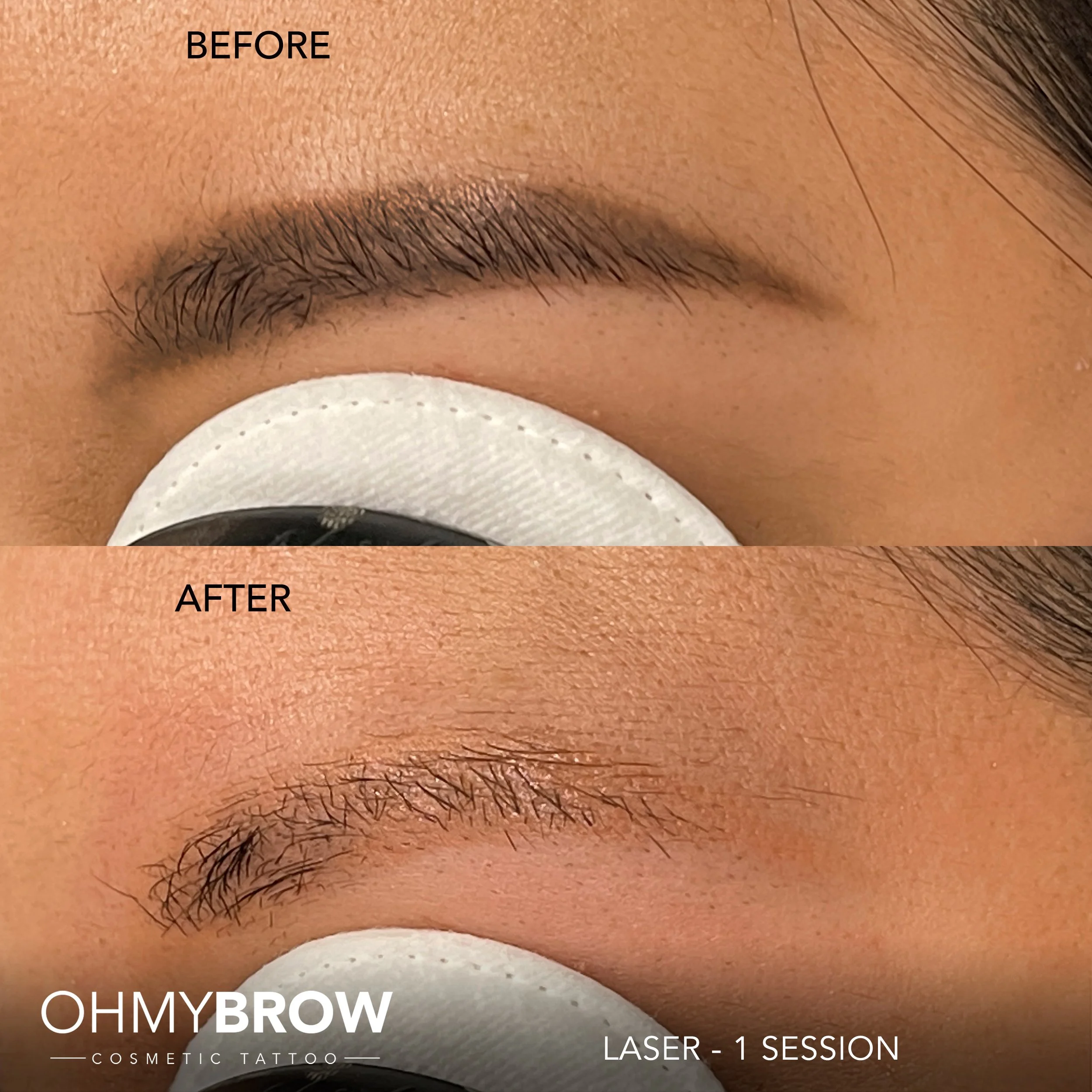 Cosmetic Tattoo Removal Adelaide Australia — OHMYBROW