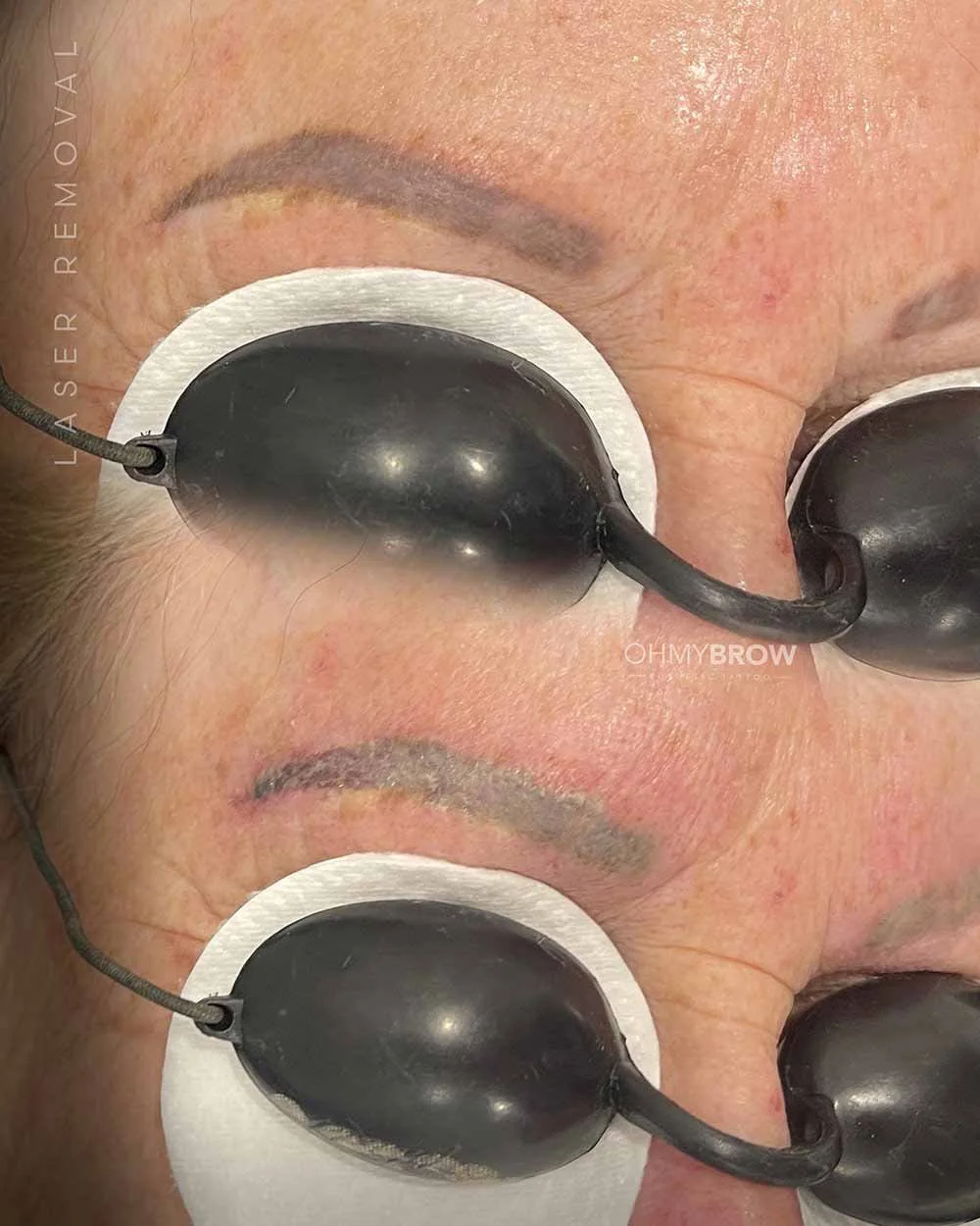 10 Laser Eyebrow Tattoo Removal Before and After Cases & What They Had ...