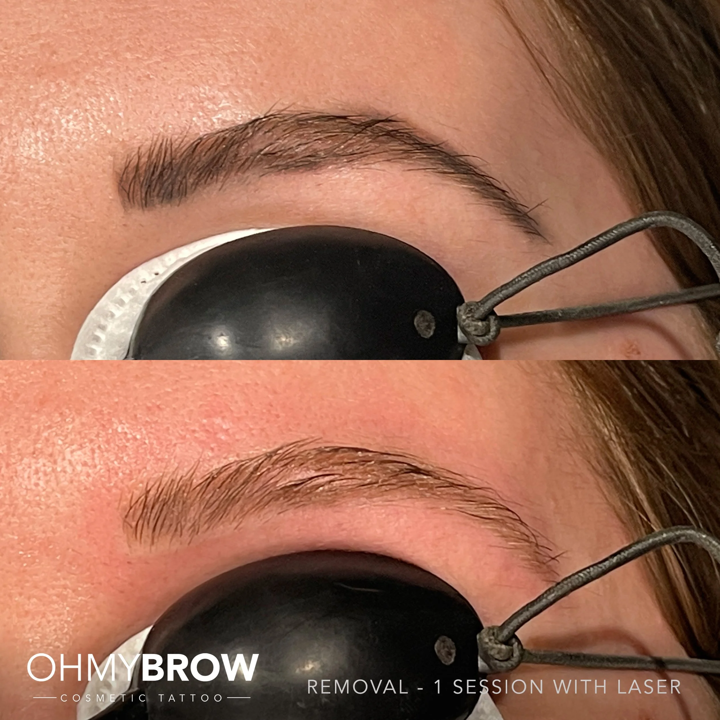 Cosmetic Tattoo Removal Adelaide Australia — OHMYBROW