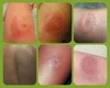 Tips For Recognising, Diagnosing and Treating Lyme Disease | Community ...