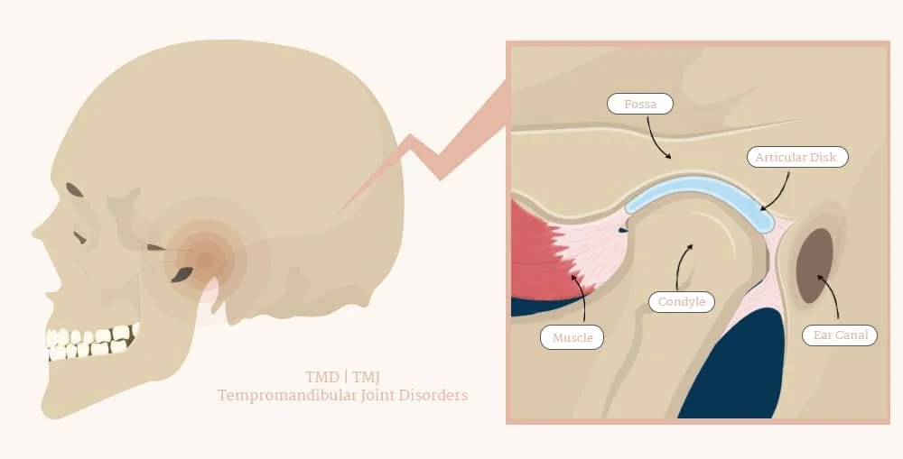 Feeling Jaw Pain? Learn About TMD Disorder & Exercises For Pain Relief