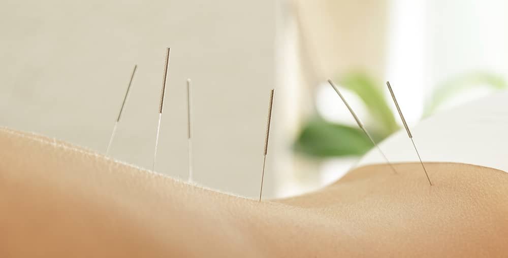 How Often Should You Get Acupuncture? What to Expect Over Time