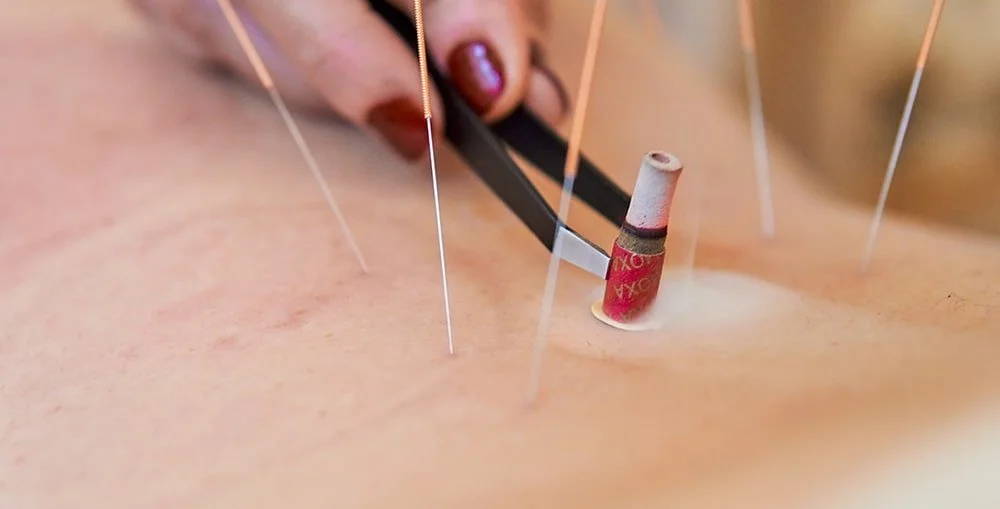 What is Japanese-style acupuncture? A Gentle Path to Healing