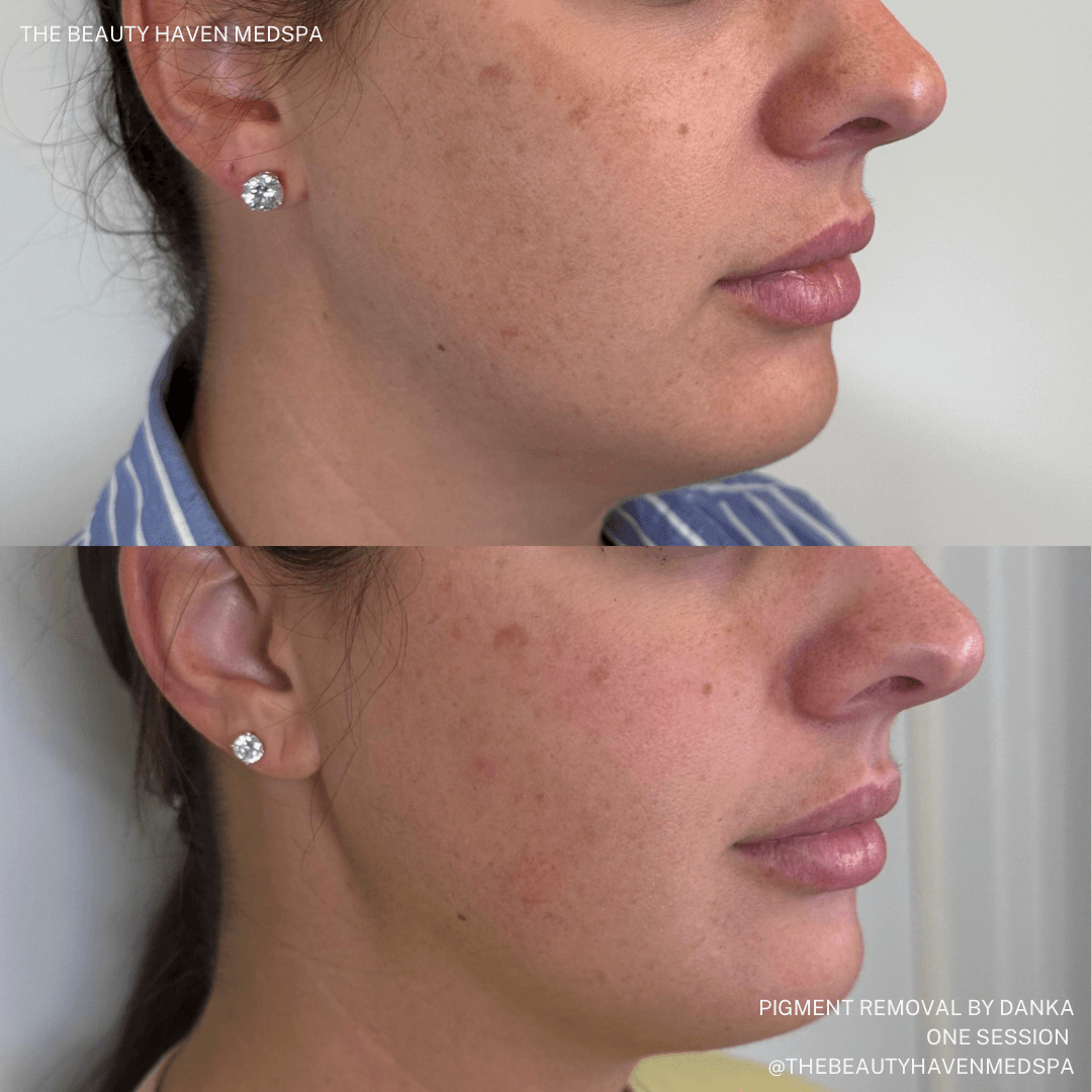 LaseMD Ultra Laser Facial - Pittsburgh PA Med Spa — The Beauty Haven Medspa