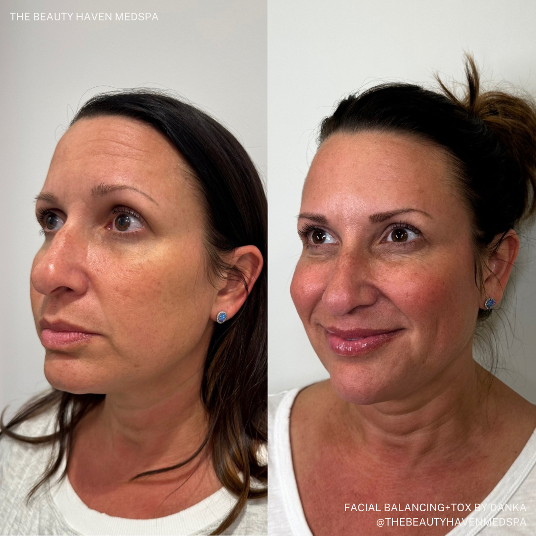 Botox Injections in Pittsburgh PA - The Beauty Haven Med Spa — The ...