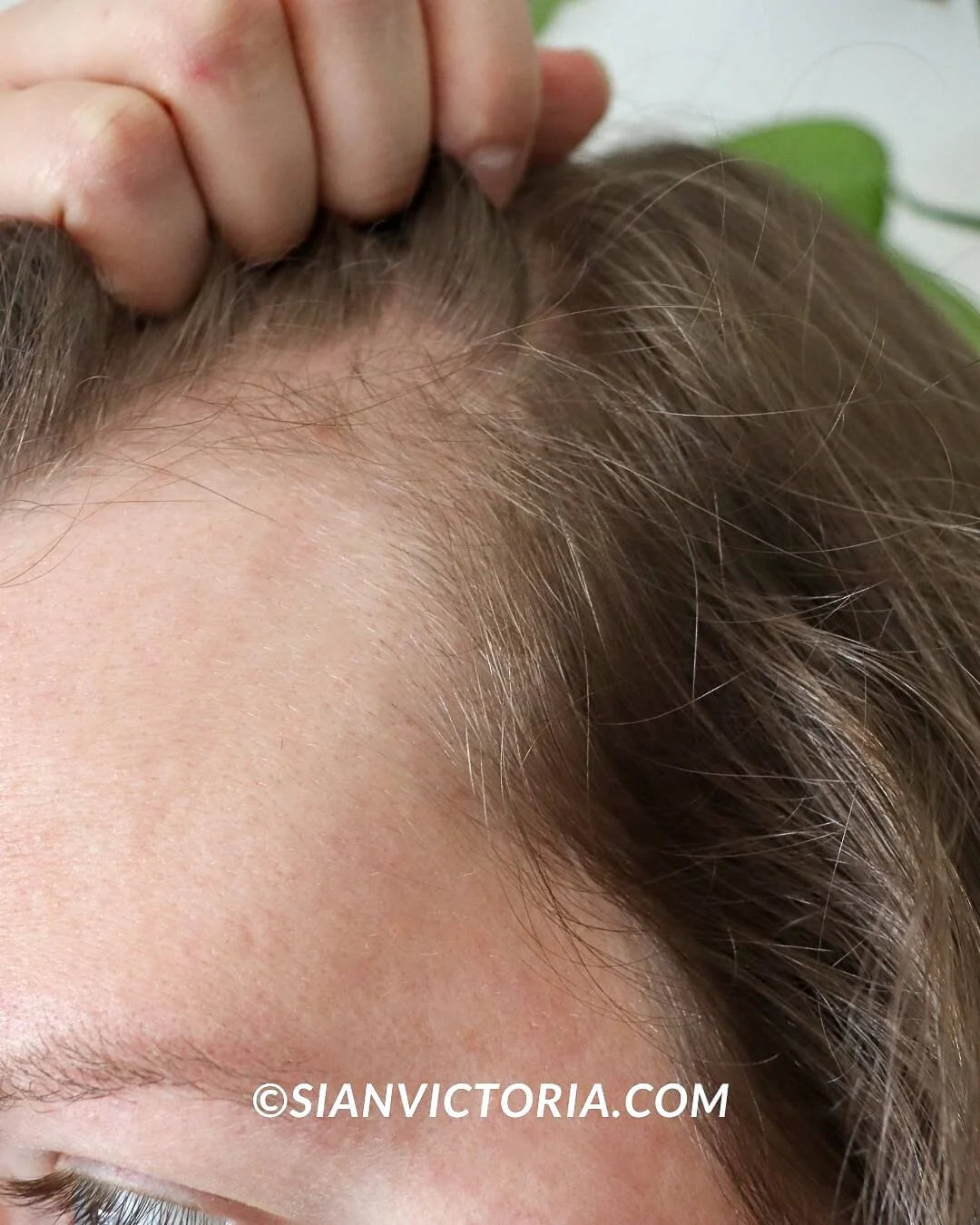 8 Things to Know About Female Pattern Baldness — sian victoria