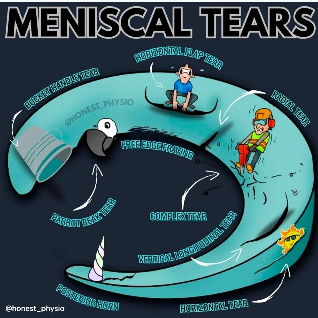 Navigating Meniscal Injuries: A Comprehensive Guide to Understanding ...
