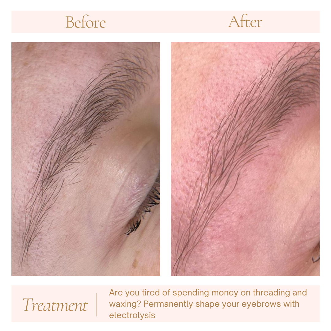 Gallery 1 Experience the best hair removal and non-invasive hair ...