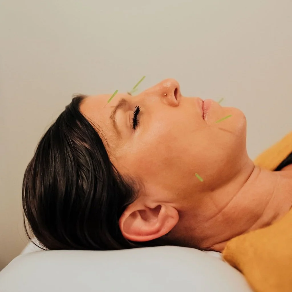 Microneedling — Ali Ali Healing