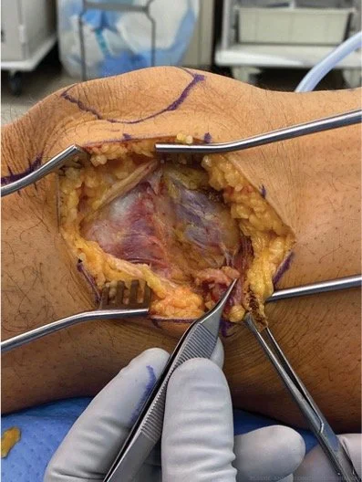 General 1 — Joint Denervation Consortium