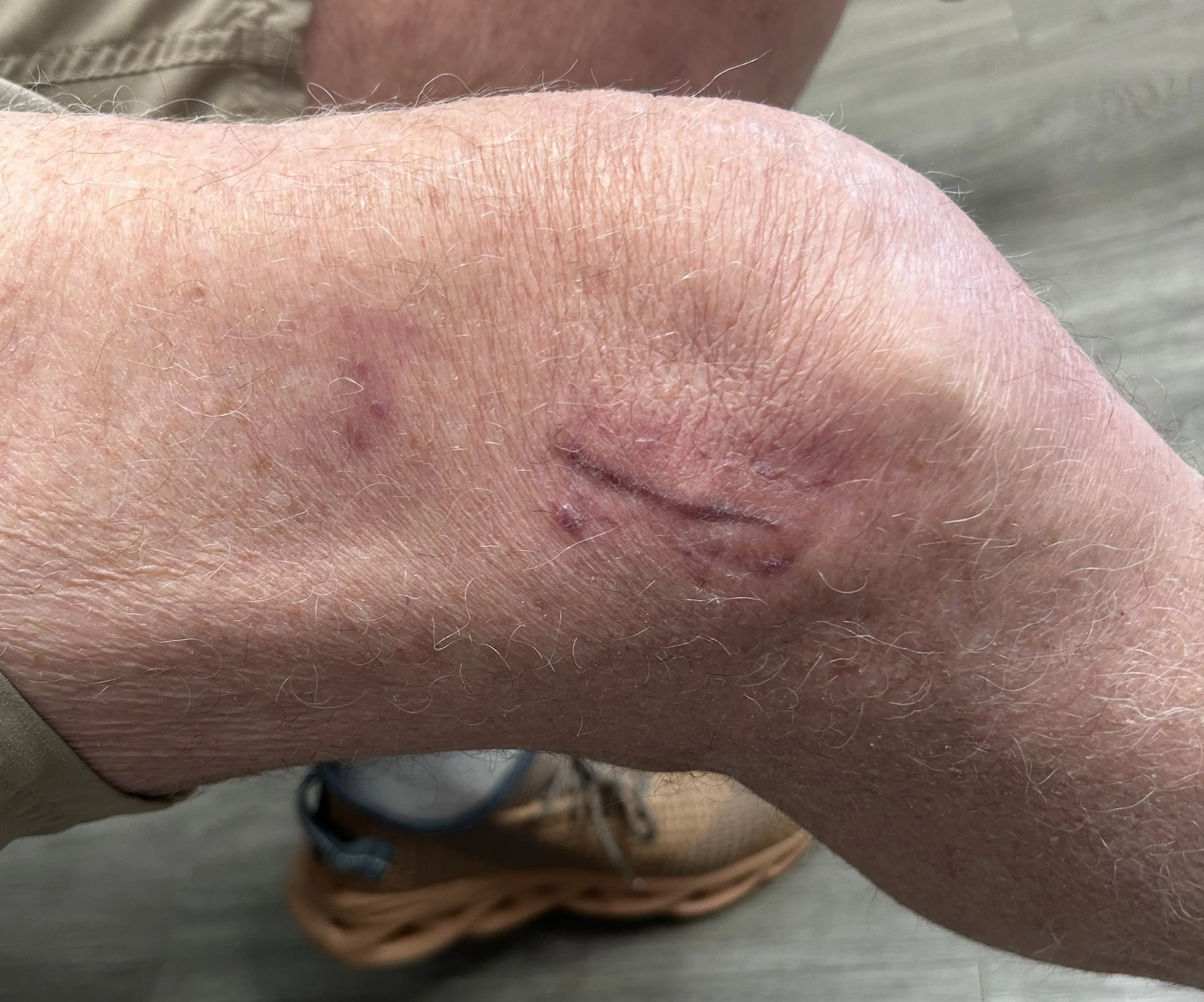 General 1 — Joint Denervation Consortium