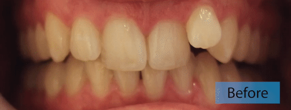 Invisalign — Seddon Dental | Gentle Dentistry in Melbourne's West