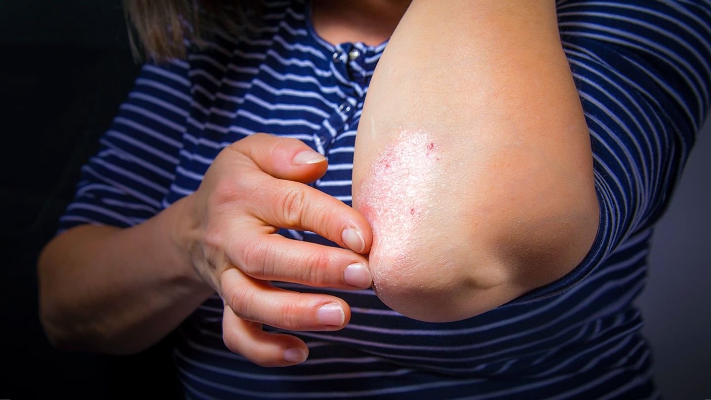 5 Signs You Might Be Dealing with Psoriasis — SUMMIT DERMATOLOGY AND ...