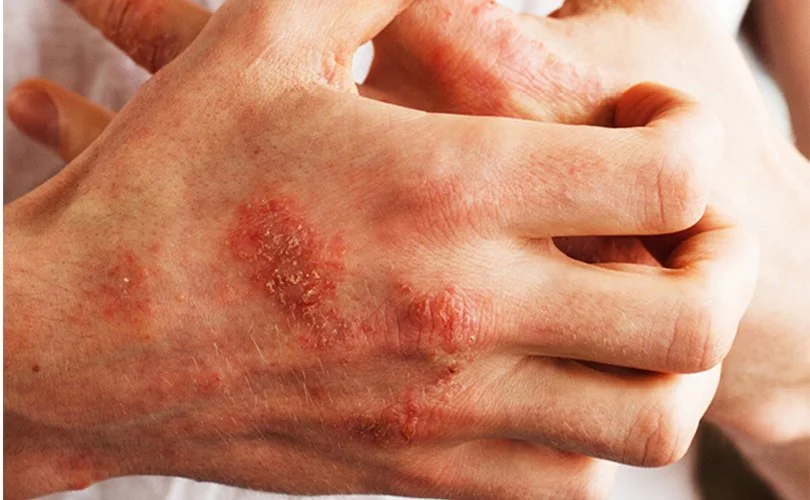 Tired of the Itch? Here's How to Beat Fungal Skin Infections and Get ...