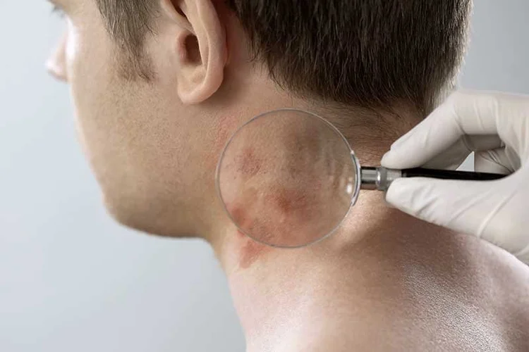 Tired of the Itch? Here's How to Beat Fungal Skin Infections and Get ...