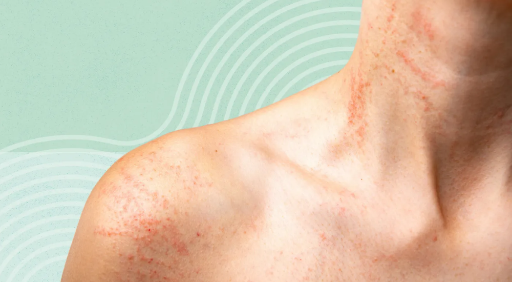 Fall Allergies and Skin: Rashes, Hives, and Itch Relief | Summit ...