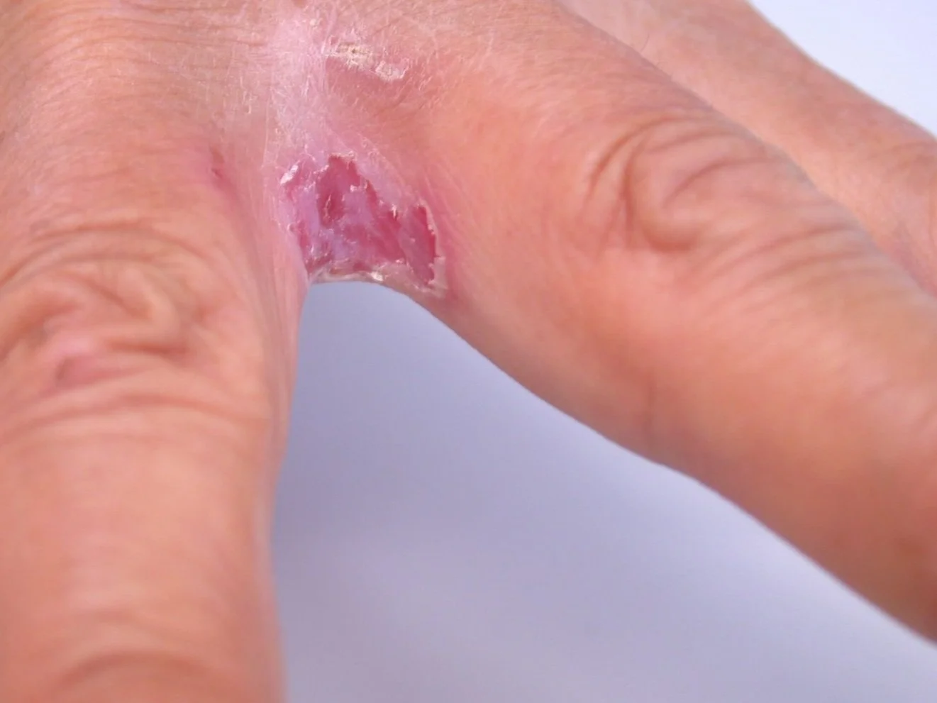 Tired of the Itch? Here's How to Beat Fungal Skin Infections and Get ...