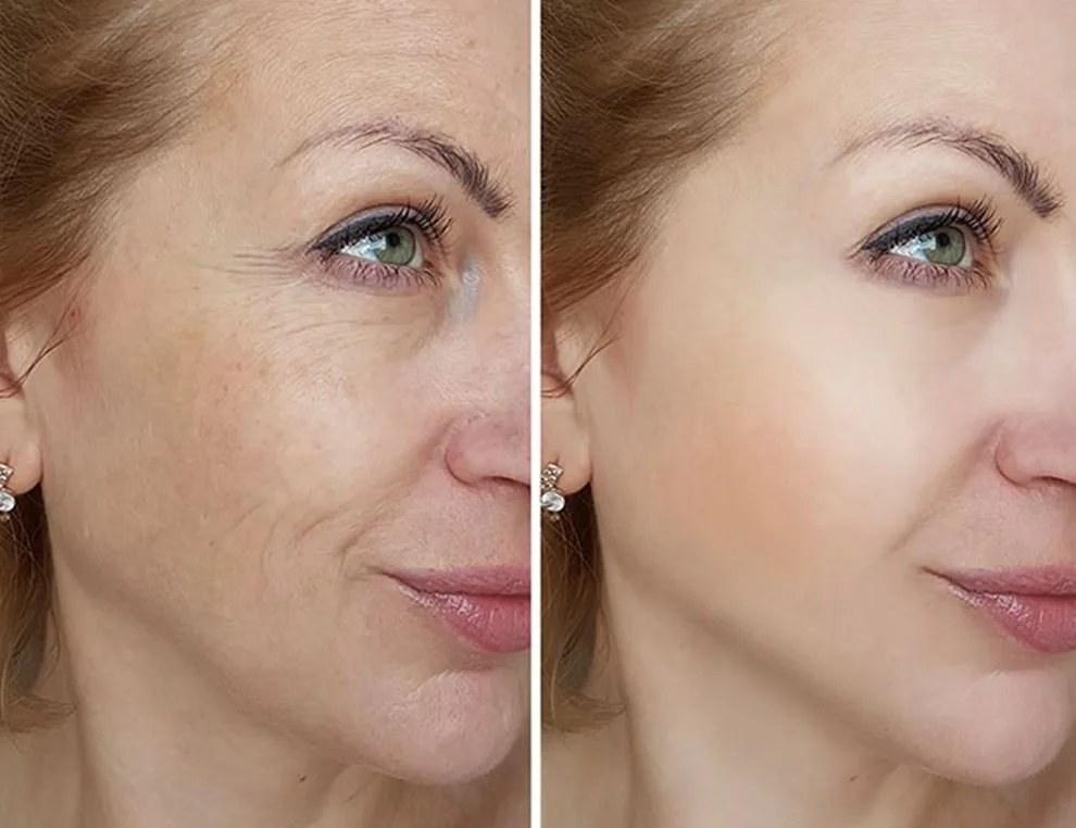 The Glow-Up You Deserve: How Laser Skin Resurfacing Can Transform Your ...
