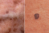 How to Tell the Difference Between Solar Lentigos and Skin Cancer – And ...