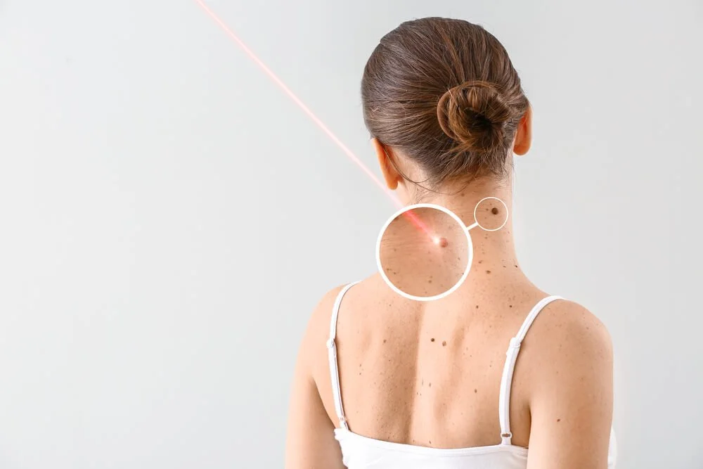 Skin Cancer Treatment in Antioch, TN — Just Skin Dermatology