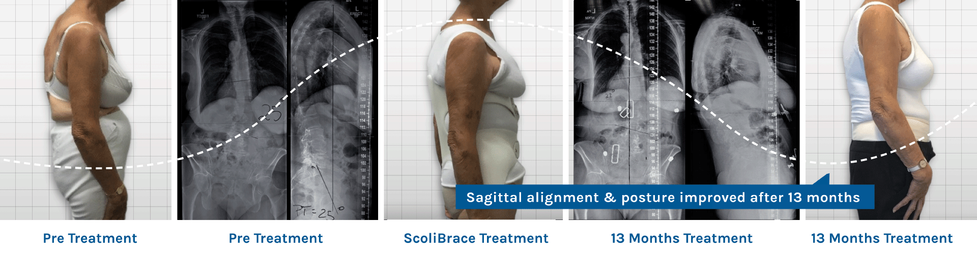 Scoliosis Treatment | Explore Scoliosis Solutions – Book Your ...