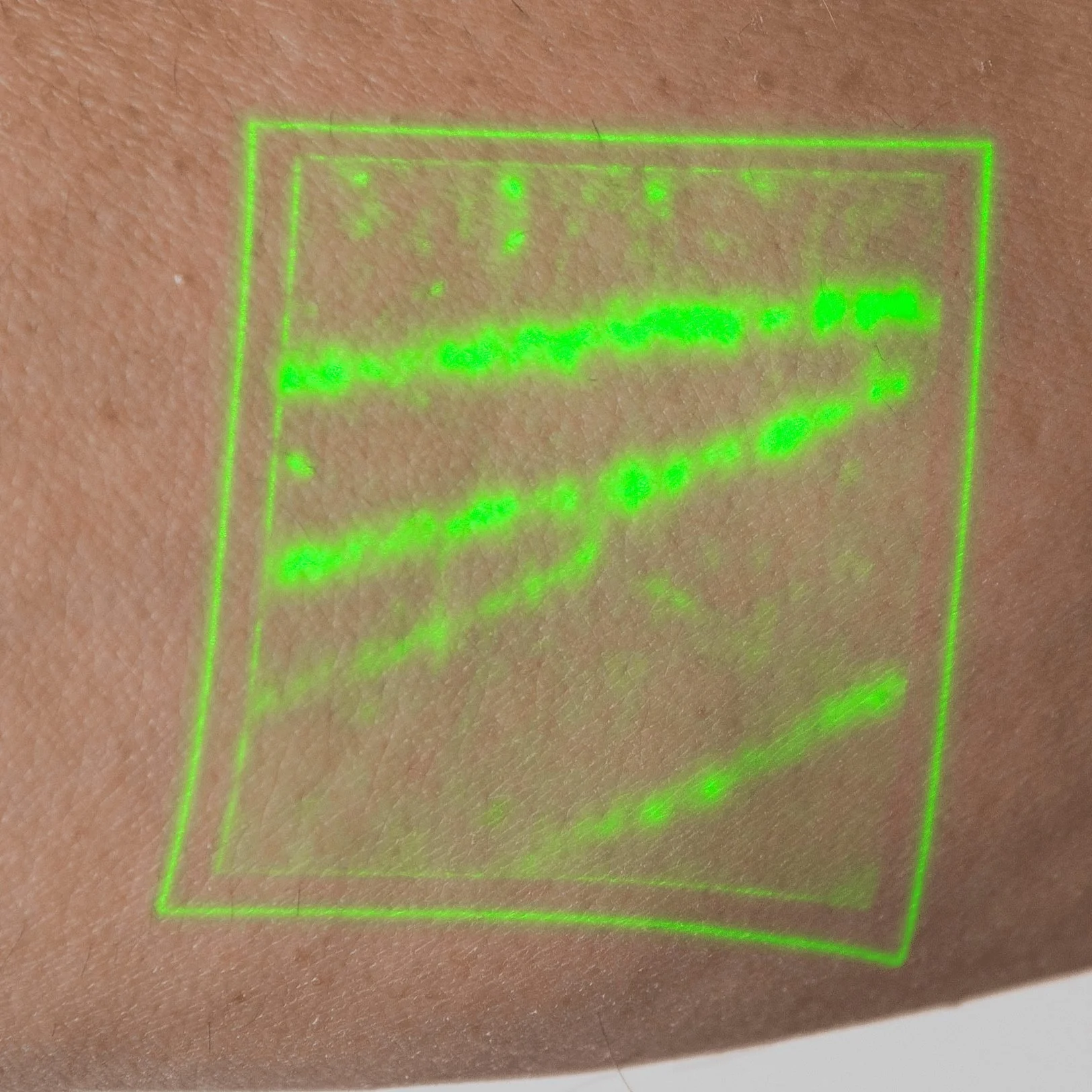 Vein Finder Device Comparison | NextVein Australia — Nextvein