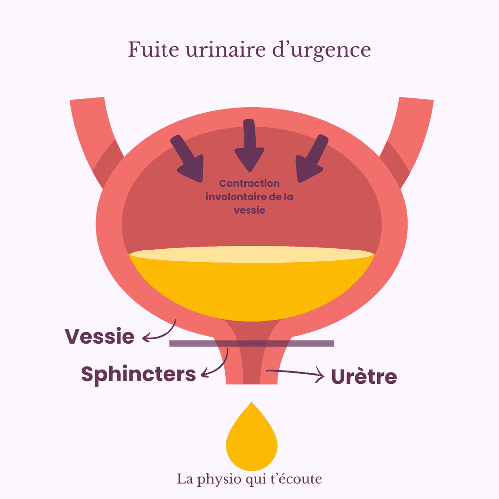 C’est quoi une vessie hyperactive? | La physio qui t'écoute | Physiothérapie pelvi-périnéale en ...