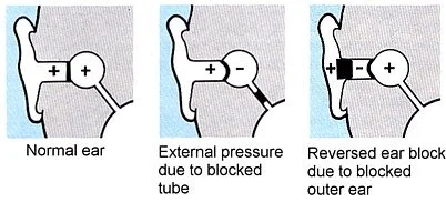 Flying and Diving — TOLBECS EAR CLINIC