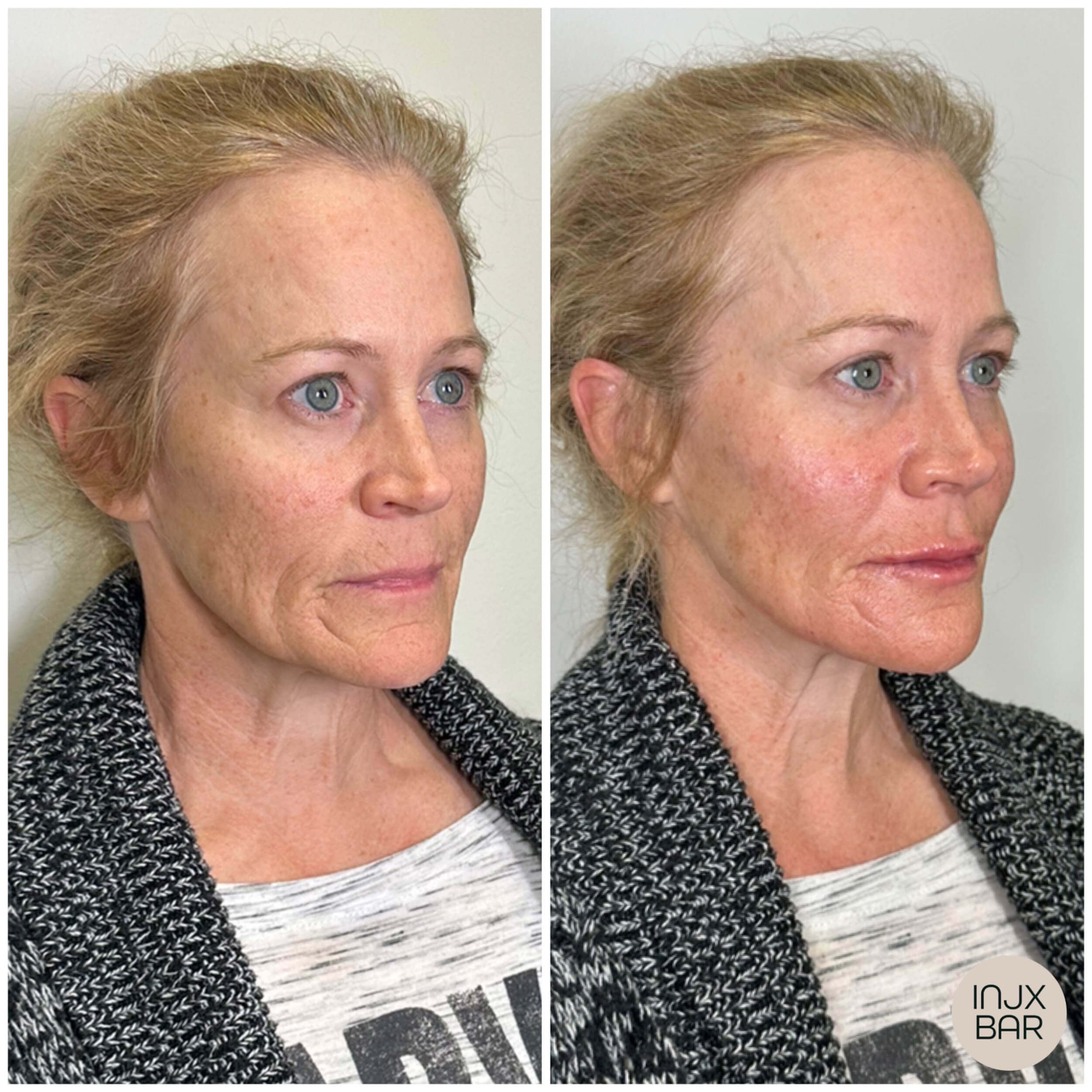 Facial Balancing with Dermal Filler: Lips, Cheeks, Under Eyes in AZ