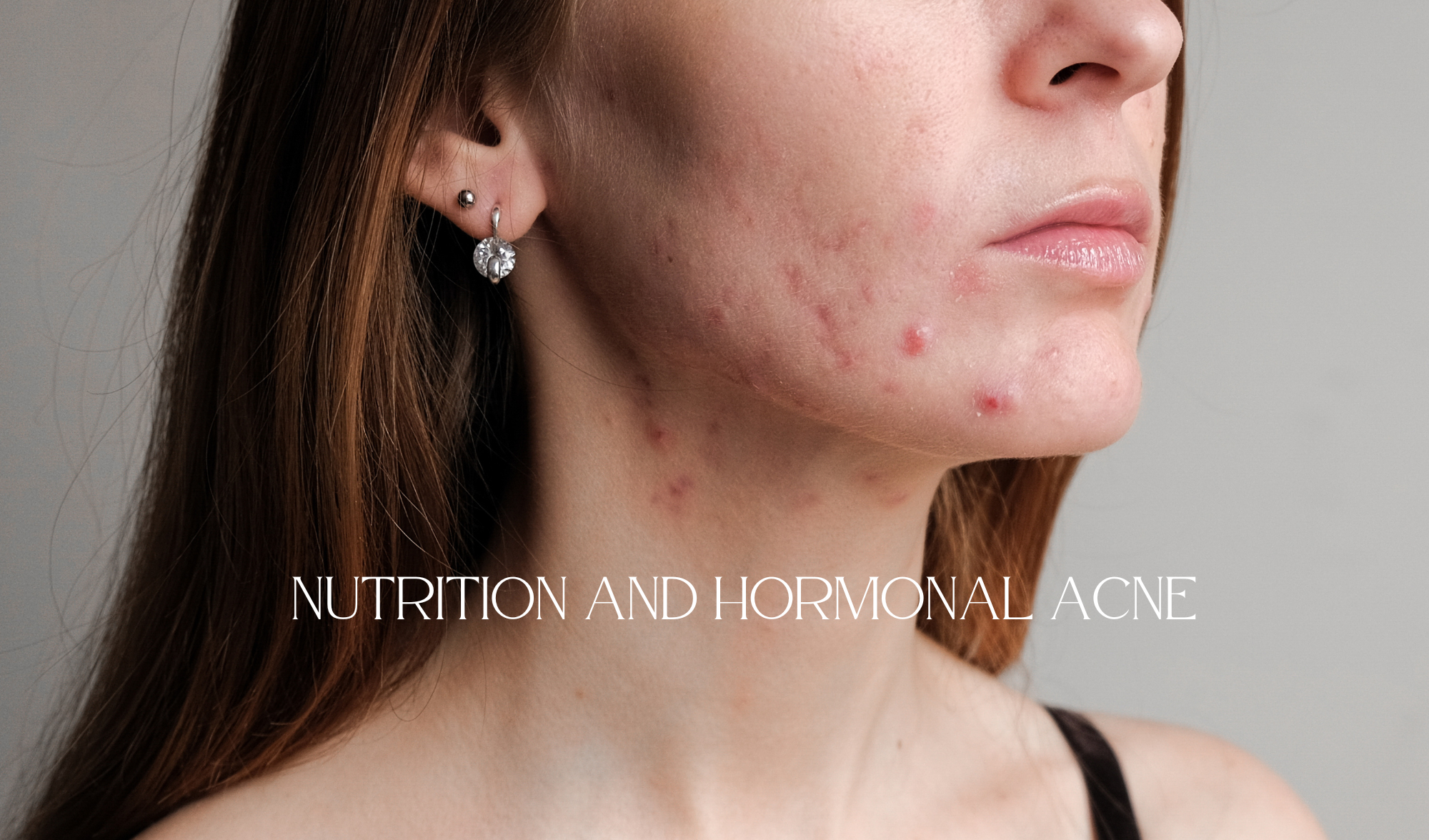 PCOS, Hormonal Acne & Nutrition: What Should I Eat and What Should I ...